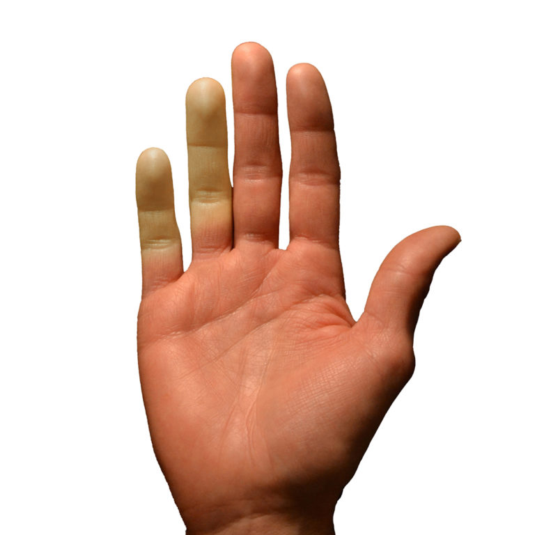 What are the symptoms of occupational disease? - Nordic Automation Systems